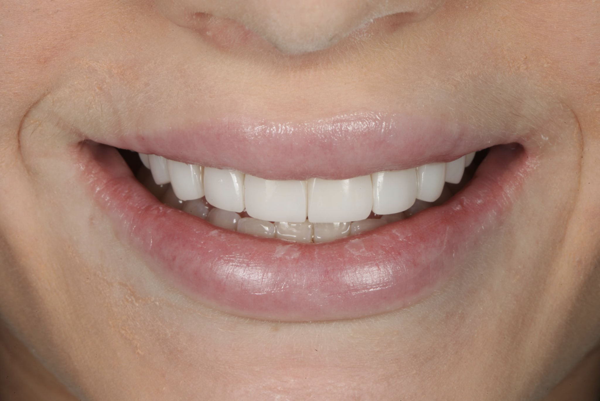 Composite Veneers Essex | FACEMED Clinic